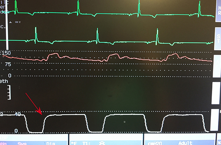 Image Gallery: Capnography | Clinician's Brief