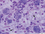 Clinical Image Bone Marrow Aspirate