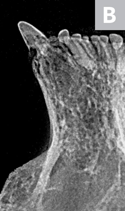 Crown Amputation for Tooth Resorption | Clinician's Brief