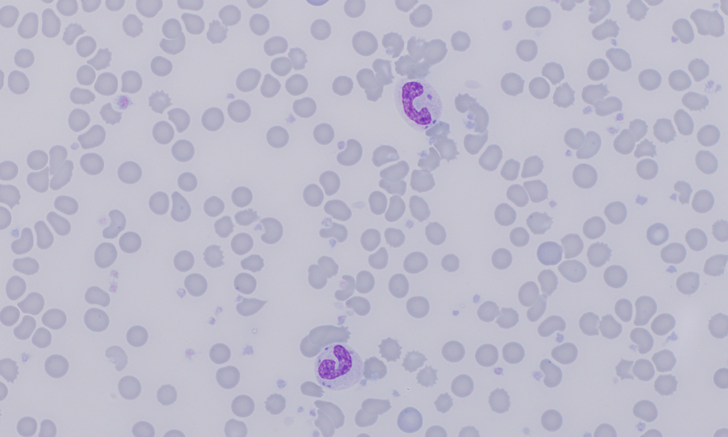 Top 5 Leukogram Patterns Associated with Abnormal Neutrophil Concentrations