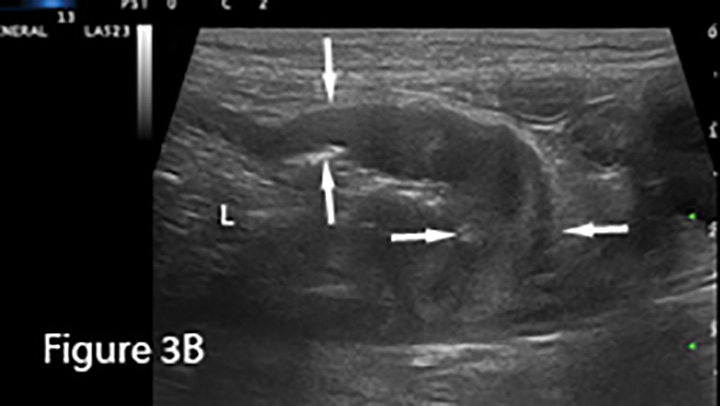 Imaging Intestinal Obstruction | Clinician's Brief