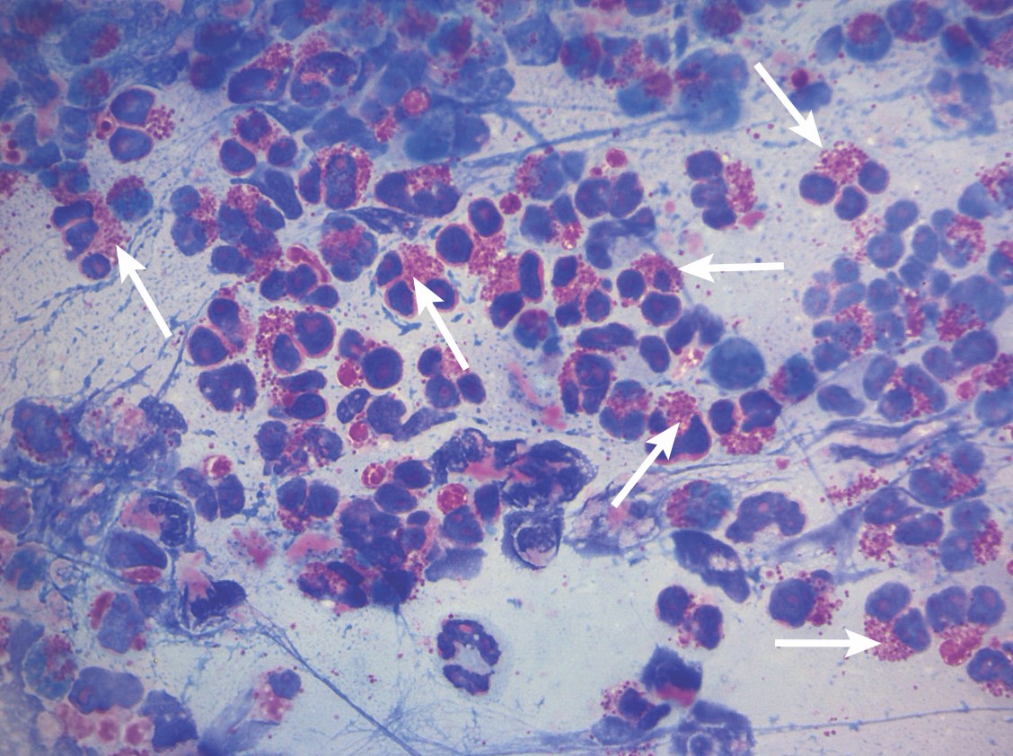Clinical Image: Transtracheal Wash Cytology