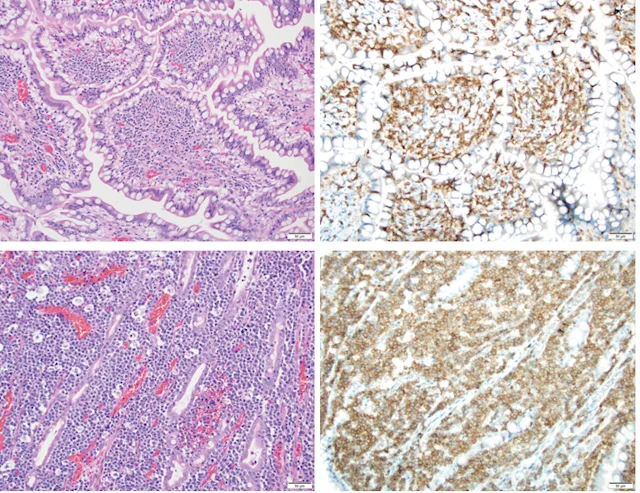 Emerging Molecular Tests for Differentiating Inflammatory & Neoplastic ...