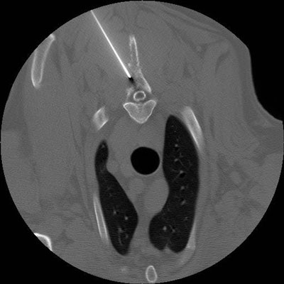 Fine-Needle Aspiration | Clinician's Brief