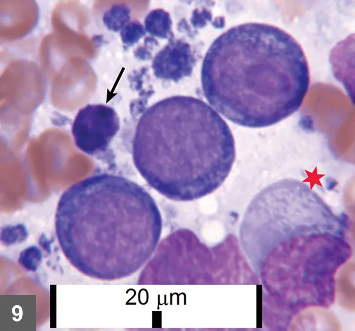 Submandibular Lymphadenopathy: The Cytologist’s Challenge