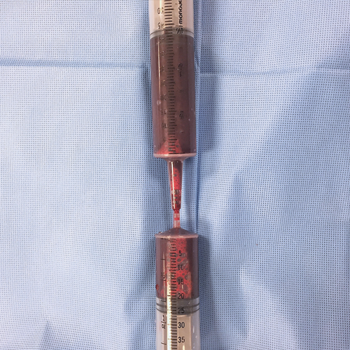 Emergency Autotransfusion | Clinician's Brief