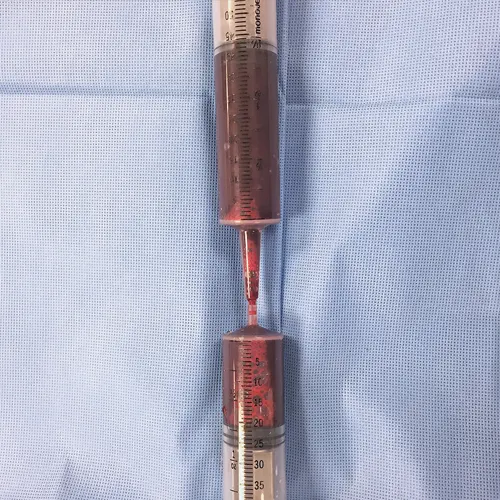 Emergency Autotransfusion