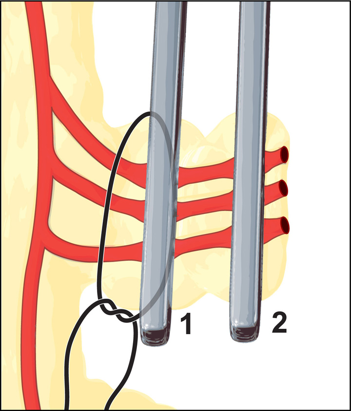 Total Splenectomy | Clinician's Brief