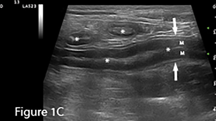 Imaging Intestinal Obstruction | Clinician's Brief
