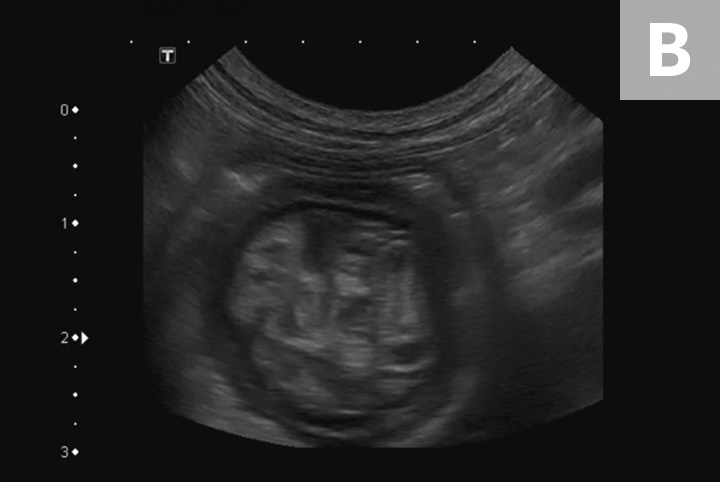 Intussusception Reduction | Clinician's Brief
