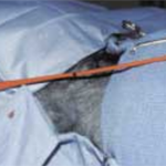 How To Place An Esophagostomy Tube | Clinician's Brief