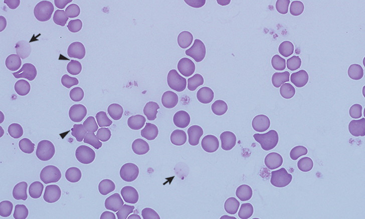 RBC Morphology Interpretation & Blood Film Review