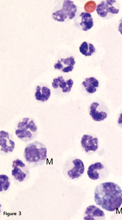 Body Cavity Effusions: Two Case Studies | Clinician's Brief