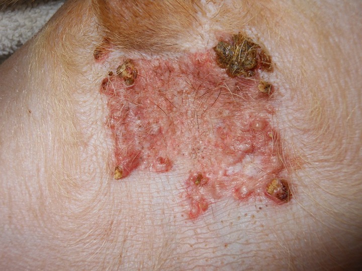 Clinical Image: What Is This Lesion?