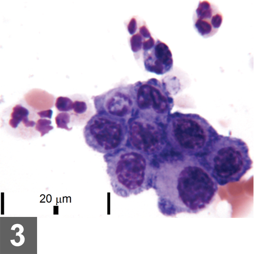 Atypical Transitional Epithelial Cells | Clinician's Brief