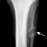 Hairline Bone Fracture | Clinician's Brief