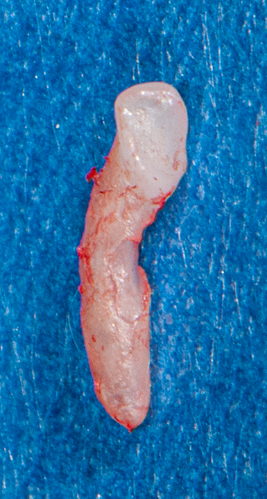 Crown Amputation for Tooth Resorption | Clinician's Brief