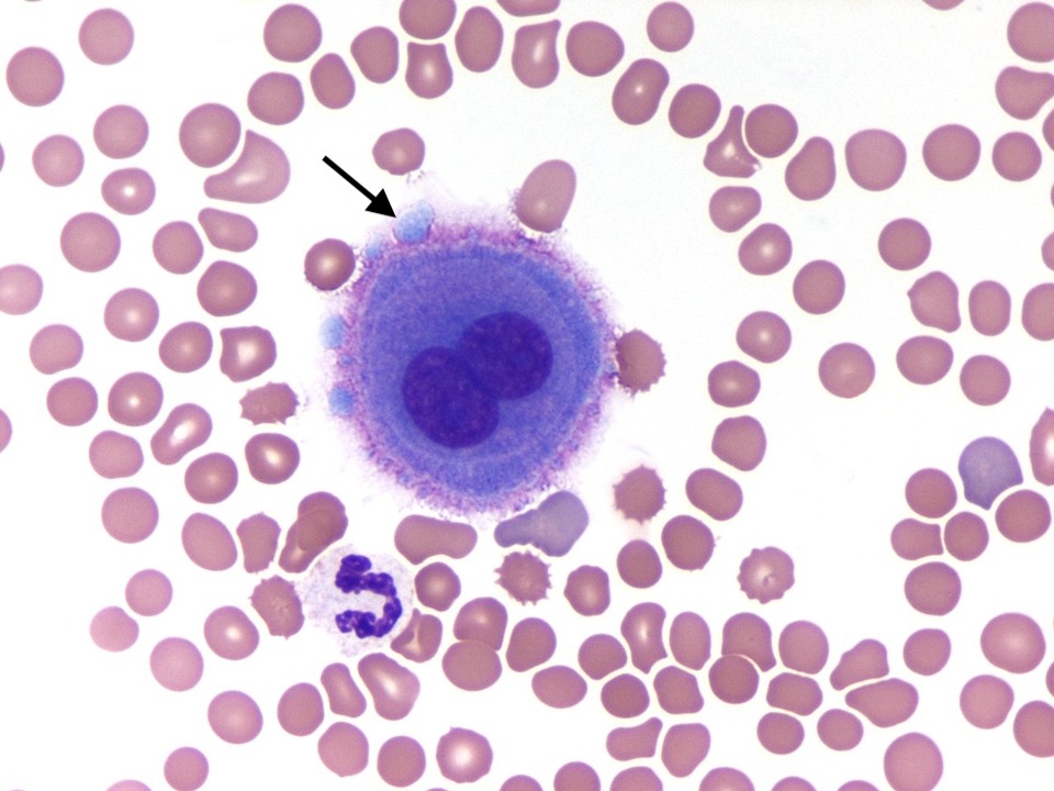 Clinical Image: Thoracic Fluid Cytology