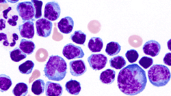 Gingival Hyperplasia | Clinician's Brief