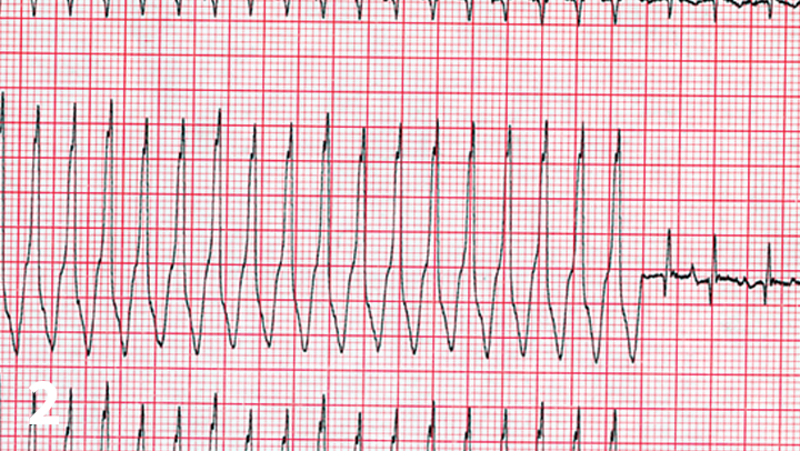 Ventricular Tachycardia | Clinician's Brief