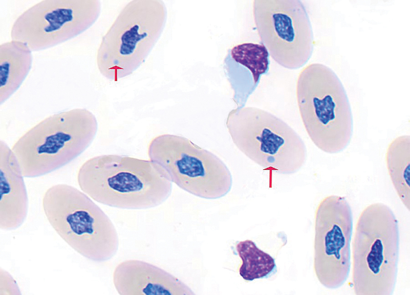Boid Inclusion Body Disease | Clinician's Brief