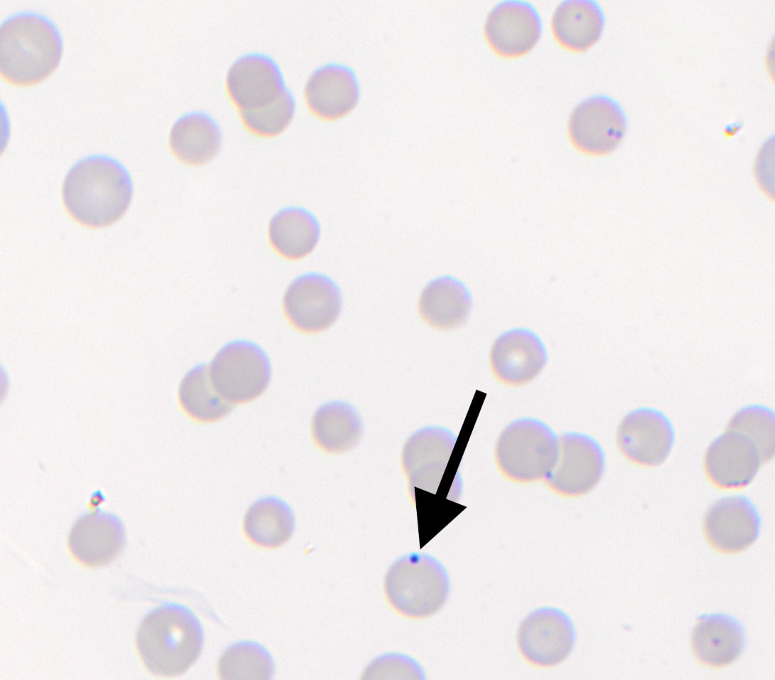 Clinical Image: RBC Inclusion