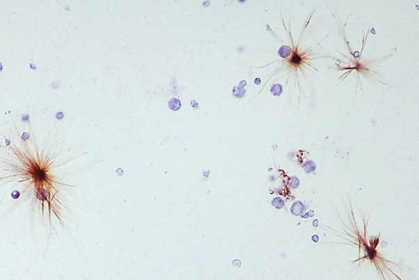 Clinical Image: What Type of Crystals Can Be Seen?
