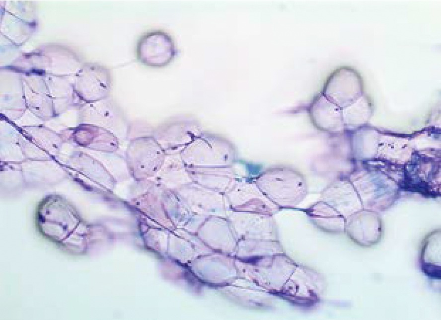 Clinical Image: Cutaneous Mass