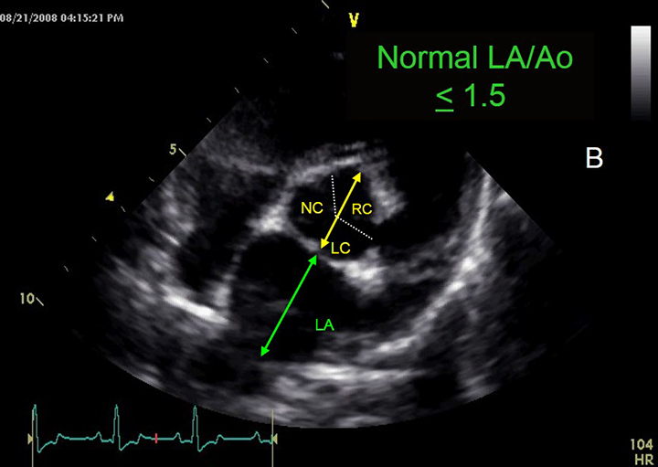 Echocardiography in General Practice: 4 Views to Master | Clinician's Brief