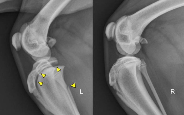 Epiphyseal Fracture X Ray