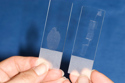 Fine-Needle Aspiration | Clinician's Brief