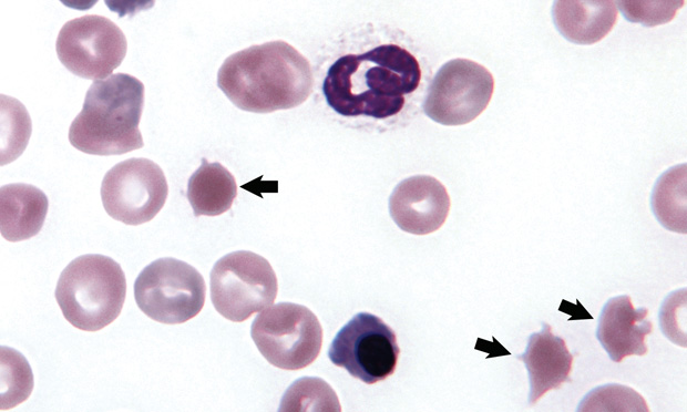 Subcutaneous Hemorrhage