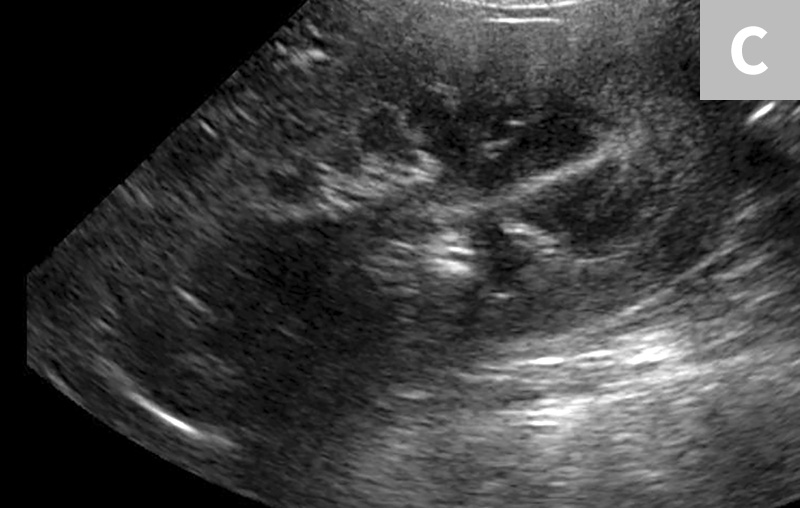 Diagnostic Imaging of Urinary Tract Calculi | Clinician's Brief