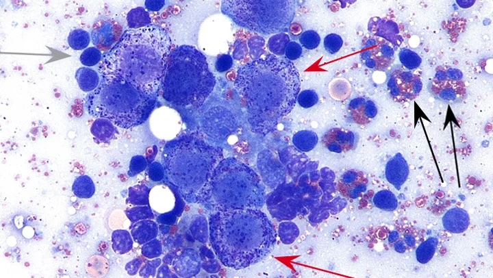 Clinical Image: Lymph Node Aspirate