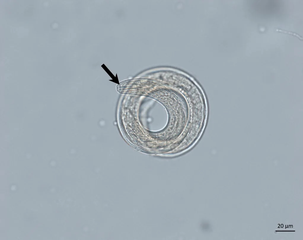 Clinical Image: Ingestion of a Parasite