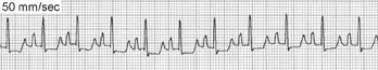 Interpreting ECGs with Confidence: Part 2