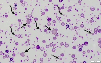 Top 5 Spurious Results on Complete Blood Count (CBC)