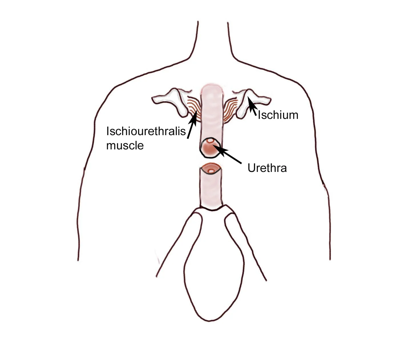 Modified Perineal Urethrostomy for Obstructed Goats