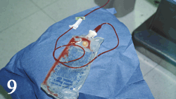 Diagnostic Peritoneal Lavage | Clinician's Brief