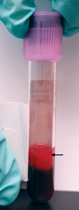 Top 5 Blood Collection & Sampling Errors | Clinician's Brief