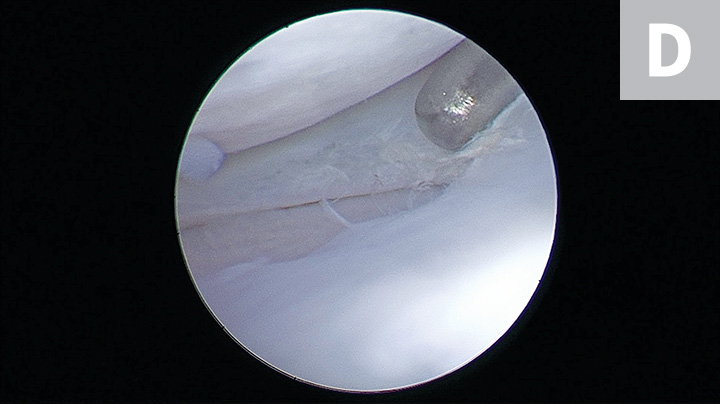 Meniscal Disease | Clinician's Brief