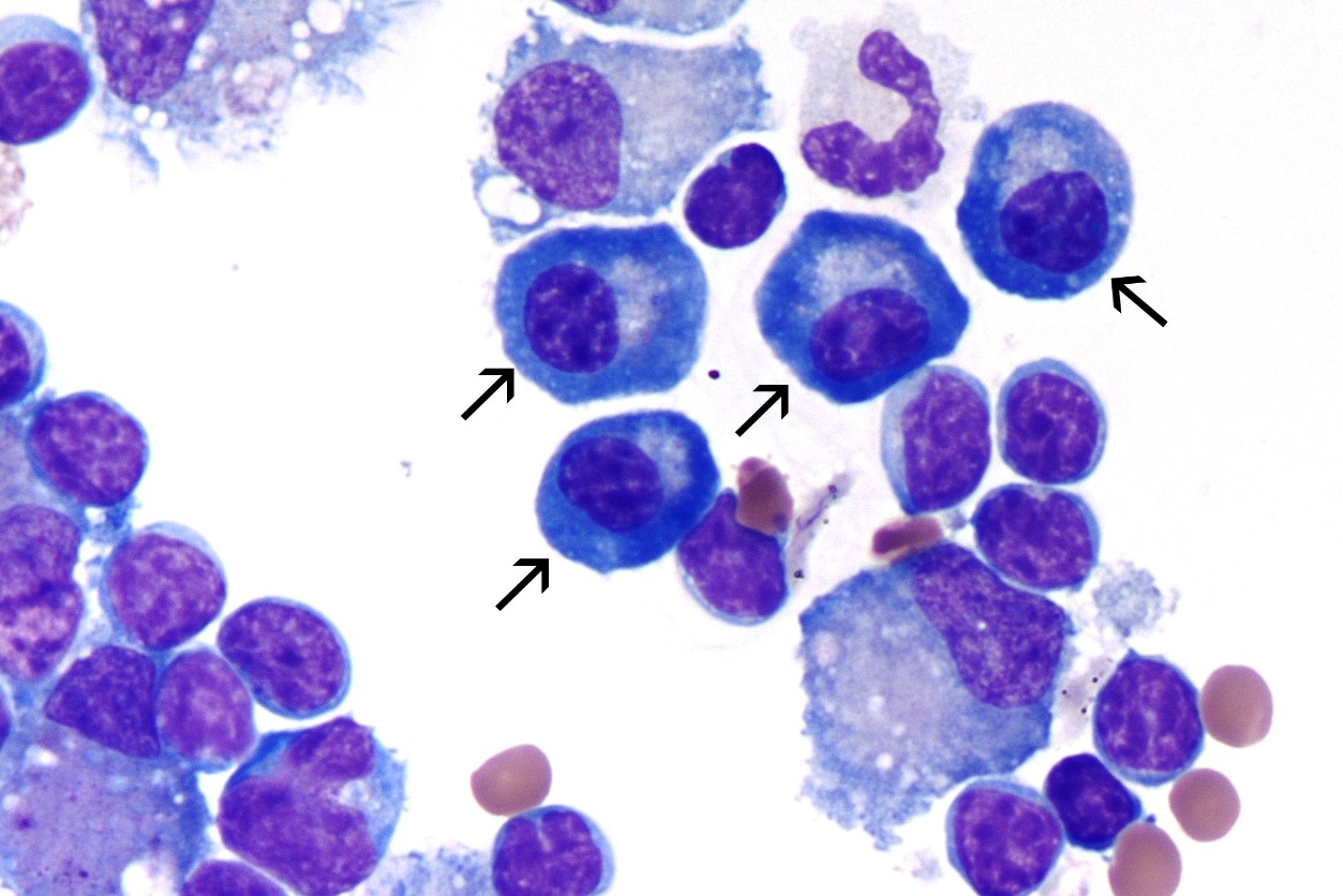 Clinical Image: Lymph Node Aspirate
