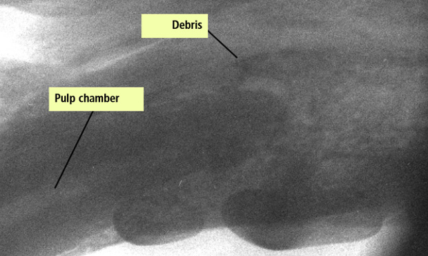 Fractured Upper Canine Tooth