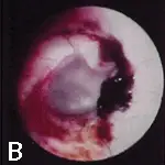 Myringotomy & Ear Disease Management