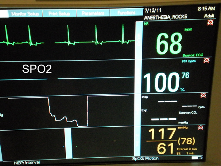 Anesthetic Monitoring: Interpreting the Readings | Clinician's Brief