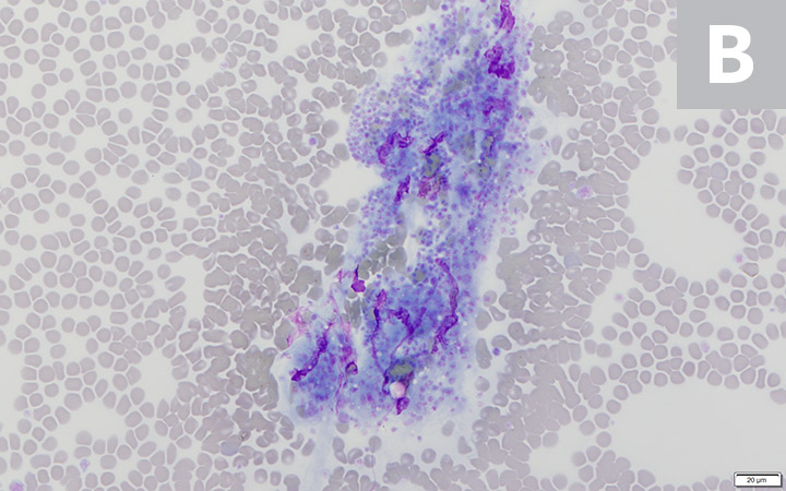 Fibrin Clot In Blood Smear