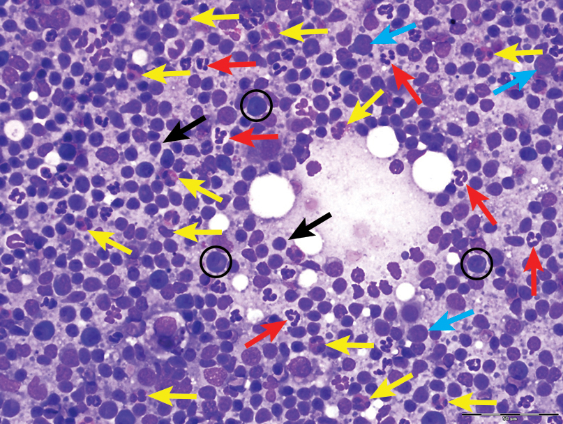 Top 5 Cytologic Findings in Aspirates of Enlarged Lymph Nodes ...