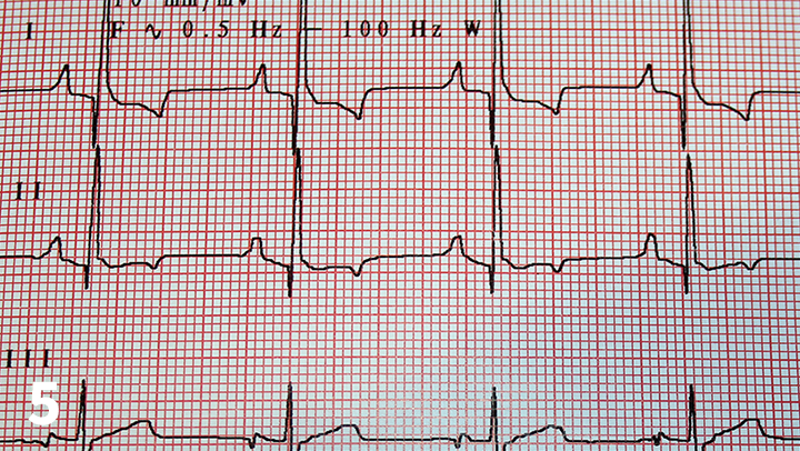 Obtaining a Diagnostic Electrocardiogram | Clinician's Brief