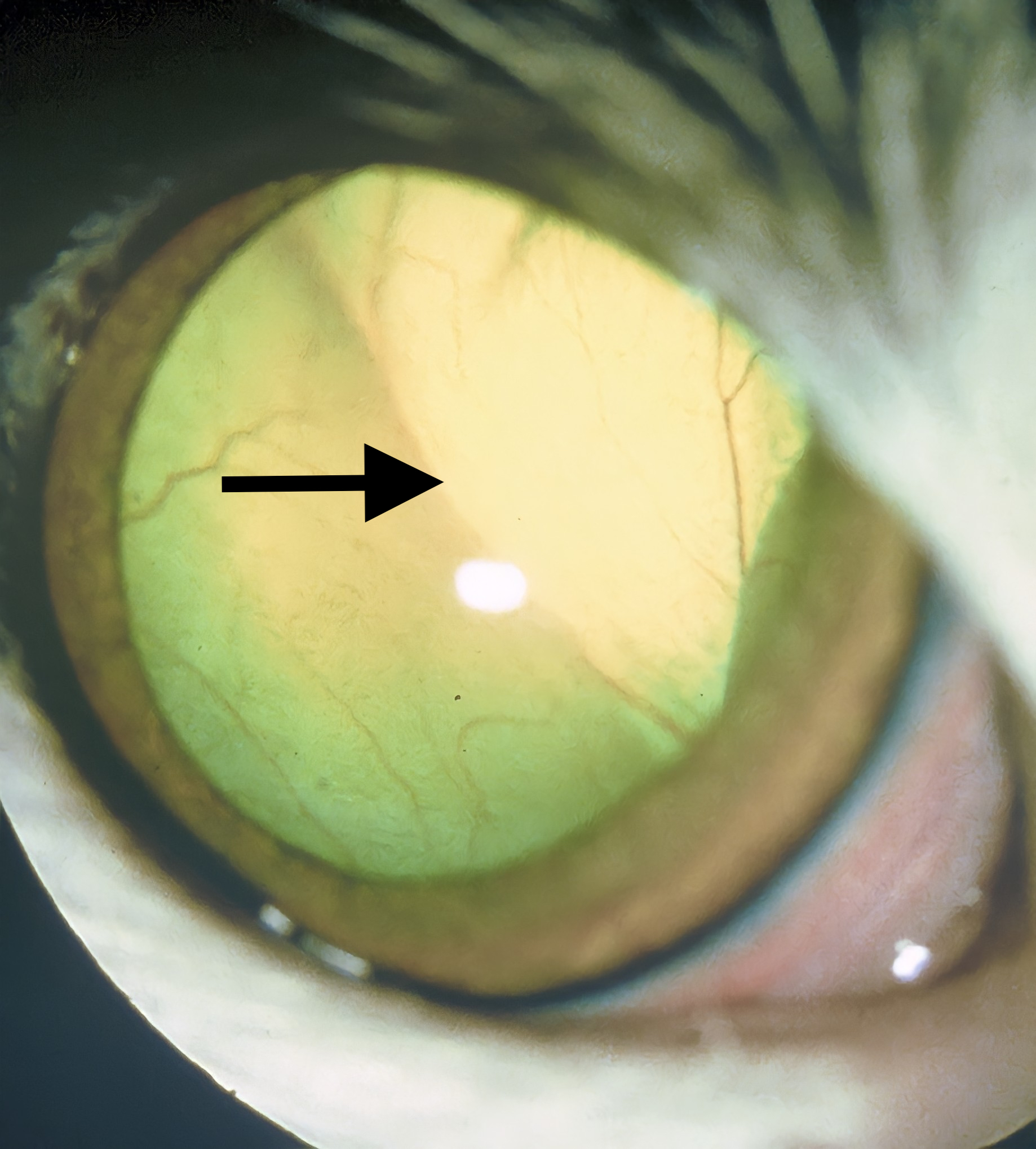 Top 5 Ocular Consequences of Systemic Hypertension | Clinician's Brief