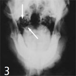 Bulla Radiography | Clinician's Brief